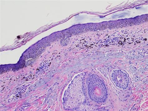 Melanoma In Situ With Partial Regression—severely Atypical Lentiginous Download Scientific