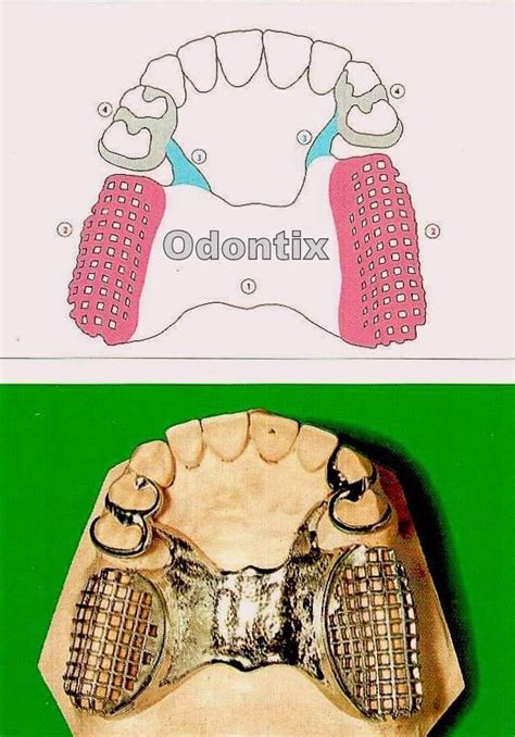 Removable Partial Denture Design Artofit
