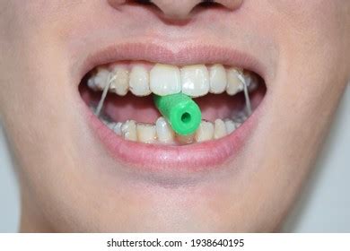 Invisalign Chewies Ultimate Guide 5 Signs You Need Them