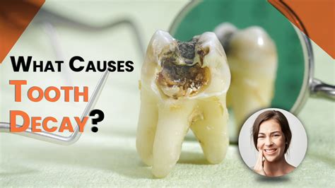 What Causes Tooth Decay
