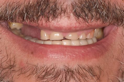 ¿qué Es El Bruxismo