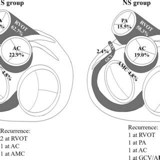 Example Of Outflow Tract Premature Ventricular Contraction OT PVC Download Scientific