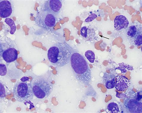 Sarcoma Eclinpath
