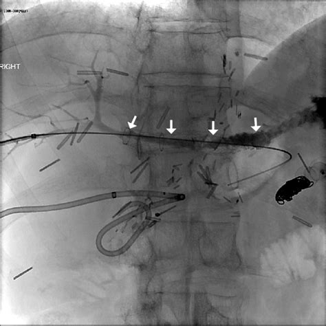 Follow Up Cholangiography After Stent Placement Showing Patent
