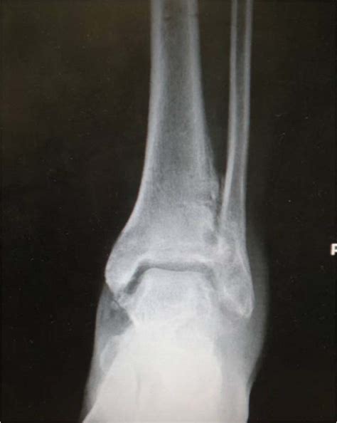 Arthrodiatasis In The Treatment Of Ankle Arthritis A Case Series The