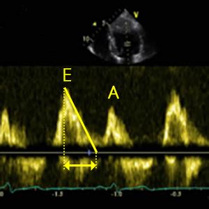 Echocardiography Diastolic Function And Dysfunction Techmed