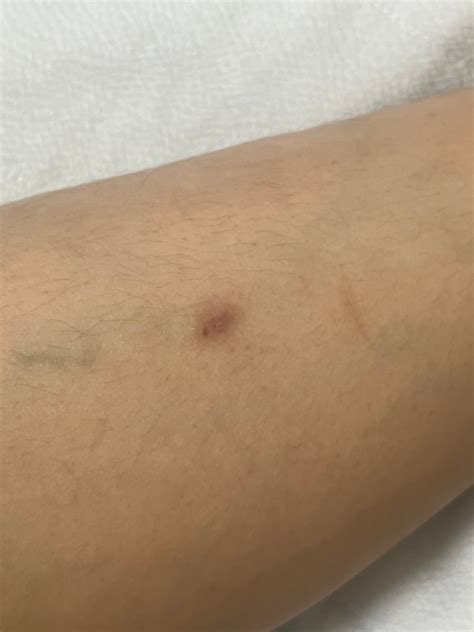 화상 자국 어떻게 없애야 할까요 지식in