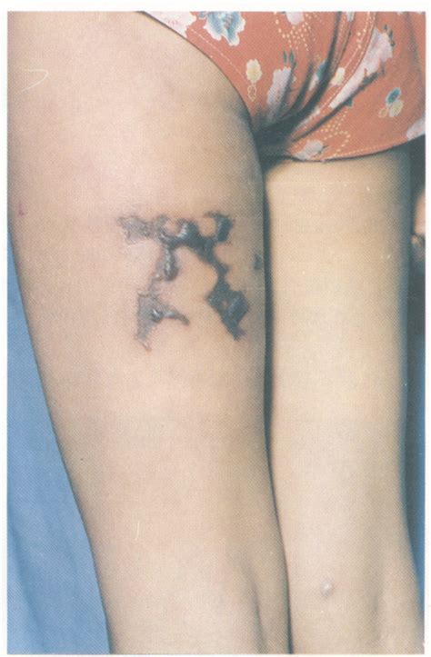 冷球蛋白血症 中国皮肤病彩色图谱