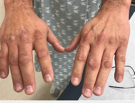 calluses on the dorsal aspect of the hands download scientific diagram
