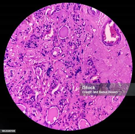 갑상선암 종양에 의해 침범된 기관선 갑상선의 전이성 유두암의 현미경 이미지 림프절 암종 갑상샘에 대한 스톡 사진 및 기타 이미지 Istock
