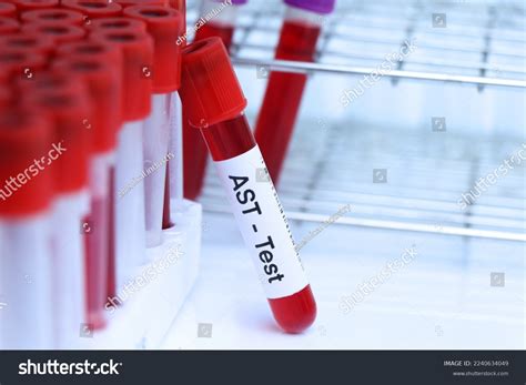 Ast Test Look Abnormalities Blood Blood Stock Photo