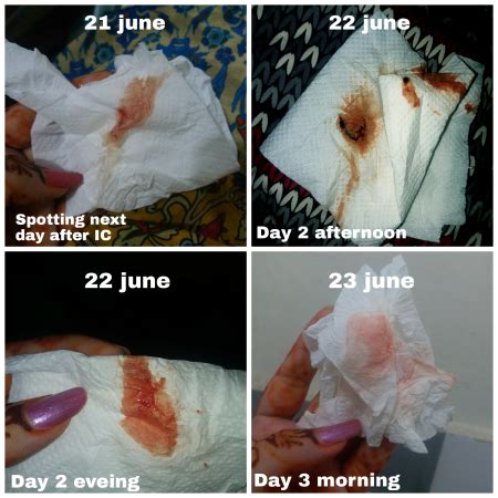 How Implantation Bleeding Look Like