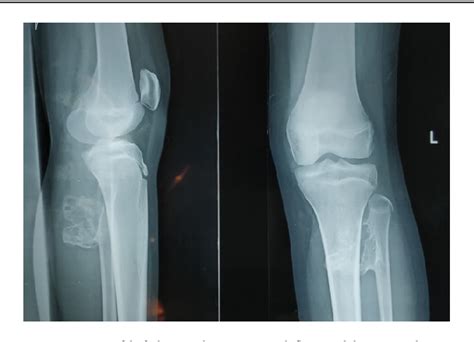 Figure 1 From A Sessile Solitary Osteochondroma In An Unusual Location Semantic Scholar