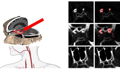 논문 리뷰 Calibrated Self Supervised Vision Transformers Improve Intracranial Arterial