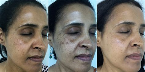 Acne Dark Spots Before And After