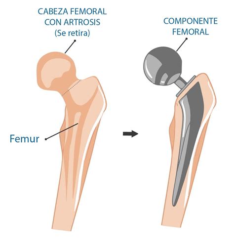 Cabeza Femoral De La Cadera