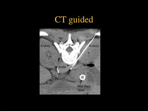 PPT Coeliac Plexus Block PowerPoint Presentation Free Download ID