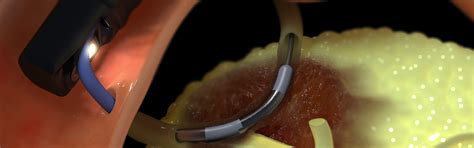 Patient Treatment Algorithm Habib™ Catheter Boston Scientific