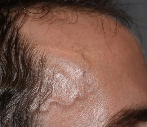 The Immediate Results Of Multilevel Temporal Artery Ligations For