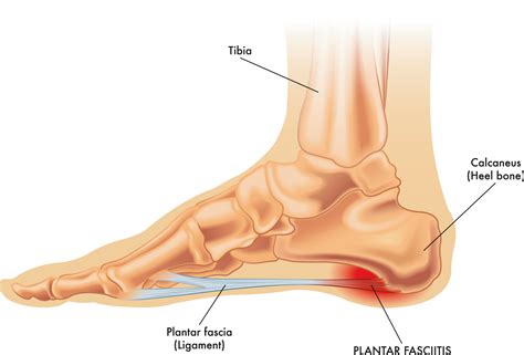 Fascitis Plantar Síntomas Y Tratamiento Clínica Dkf