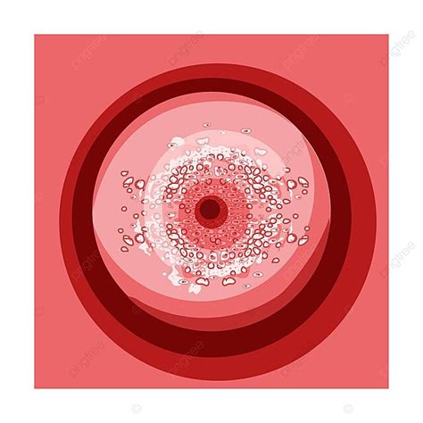 Cervical Cancer Stagesview In Female Reproductive System Biopsy Cervix