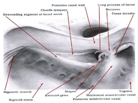 Mastoidectomy Types Indications Procedure Ppt
