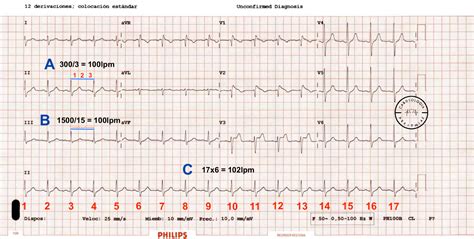 Flutter Auricular Ecg 2025