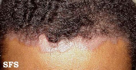 Seborrheic Dermatitis Pictures Treatment Face Scalp Newborns