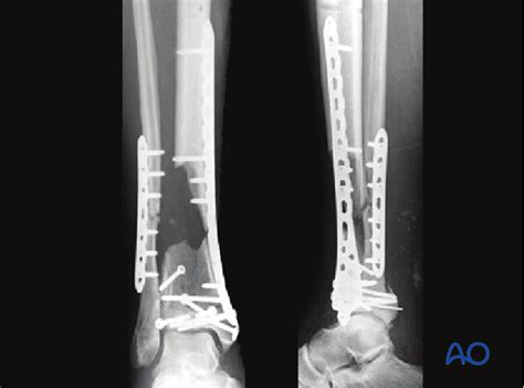Orif Plate And Screws Through Anteromedial Approach For Complete