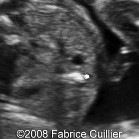 📃 Hepatic Calcifications