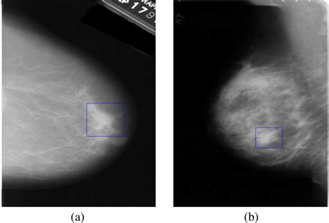 Figure 1 From Breast Mass Detection In Mammography Based On Image