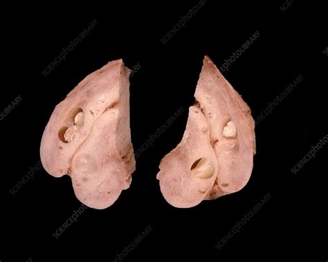 Nabothian Cysts On Cervix Stock Image C0525829 Science Photo Library
