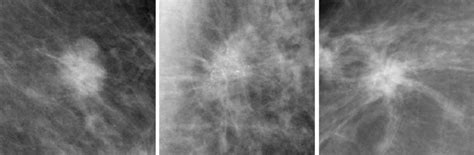 Three Real Mammographic Masses From Our Training Data Download Scientific Diagram