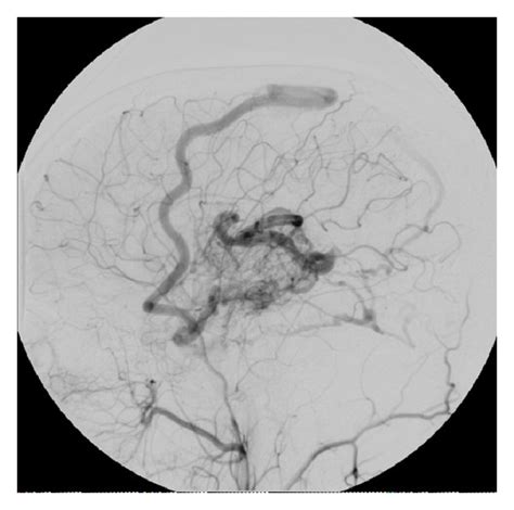 Diagnostic Cerebral Angiogram At Initial Presentation A Ap Right