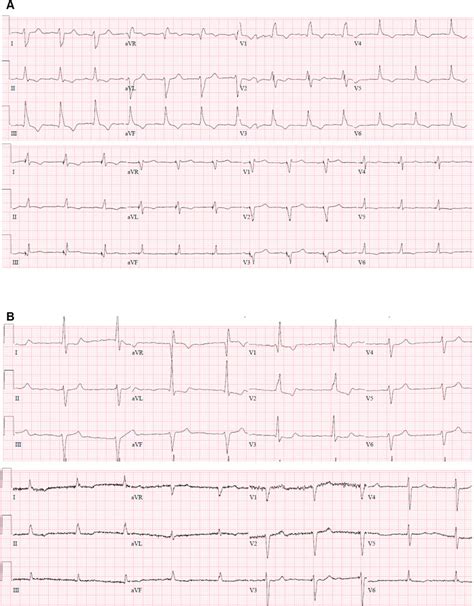 Correction Of Right Bundle Branch Block RBBB With Axis Deviation A Download Scientific