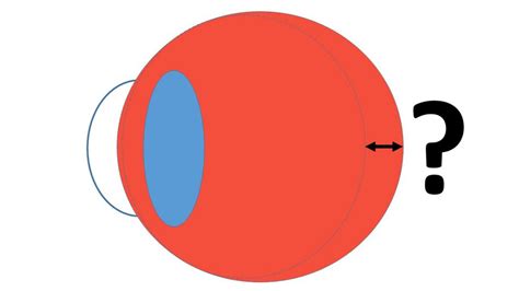 Axial Length Measurement A Clinical Necessity Myopia