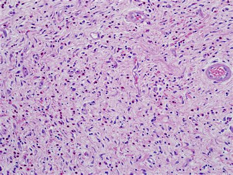 Pathology Outlines Inflammatory Fibroid Polyp