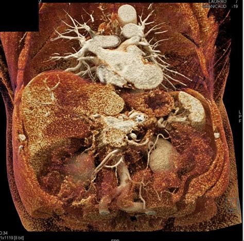 Adenocarcinoma Head Of Pancreas Pancreas Radiology Case Studies