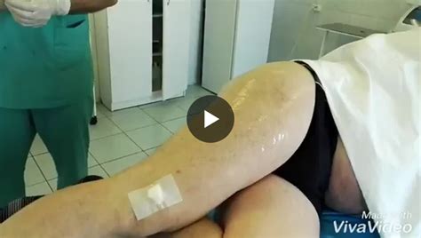 კოქსართროზი მენჯ ბარძაყის სახსრის ოსტეოართროზია ჰიალურონის მჟავა… რევმატოლოგი ირაკლი შელია