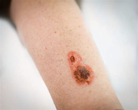 קעקוע פציעות Burn Wounds מונקו איפור