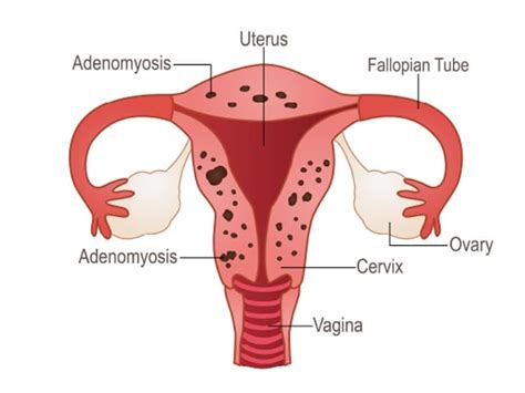 Adenomyosis Ceaps By Gaby Moawad Md