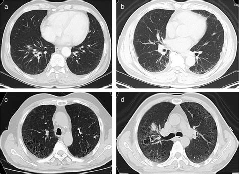 A Honeycombing Score 0 No Discrete Honeycombing With Interlobular Download Scientific