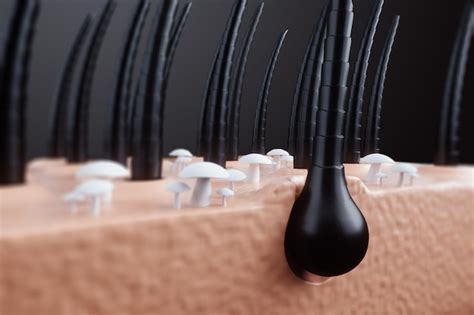 Premium Photo Fungal Disease Of The Skin Dandruff On The Scalp An Enlarged Image Of The Hair