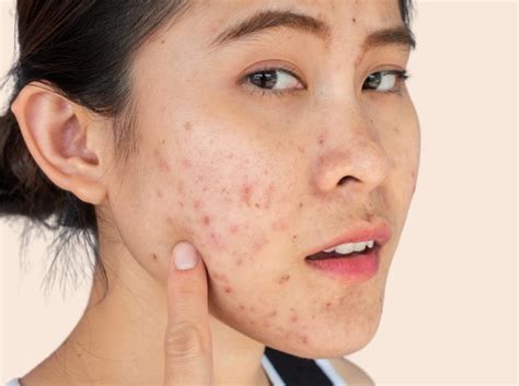 List Of Ways To Fade Dark Scars On The Face From Natural To Medical Moc Kim Spa Beauty