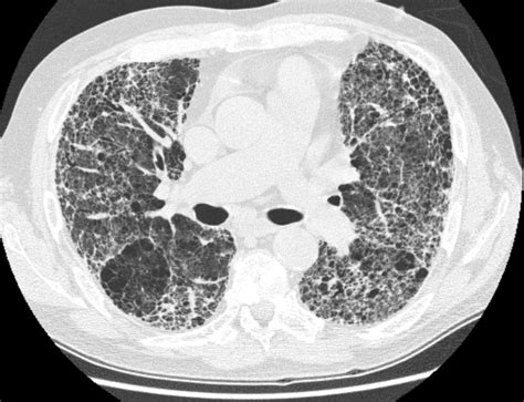 Pulmonary Fibrosis Pulmonary Fibrosis