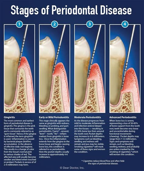 Understanding Periodontal Pockets Dental Assistant Study Dental
