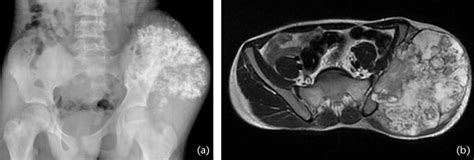 A X Ray Of Secondary Chondrosarcoma Developing In A Prior Download Scientific Diagram