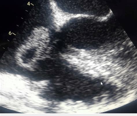 Tee Showing Large Vegetation Of Tricuspid Valve With Central