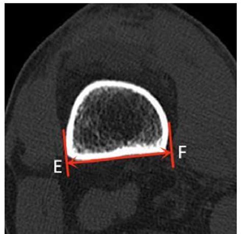 Pdf Ct Based Morphological Analysis Of The Distal Femur In Patients With Trochlear Dysplasia