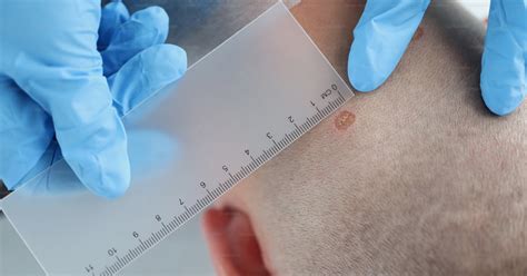 Dermatologist Doctor Examine Patient Mole In Dermatology Clinic